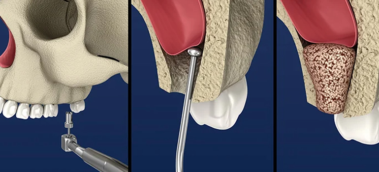 Sinus Lifts Procedure | The Func Dental